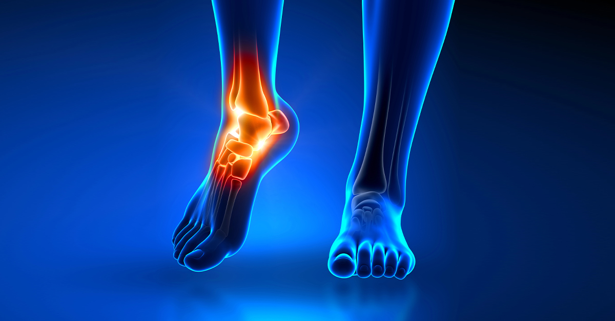 How Do I Know if My Ankle Fracture Is Serious? - Nilssen Ankle