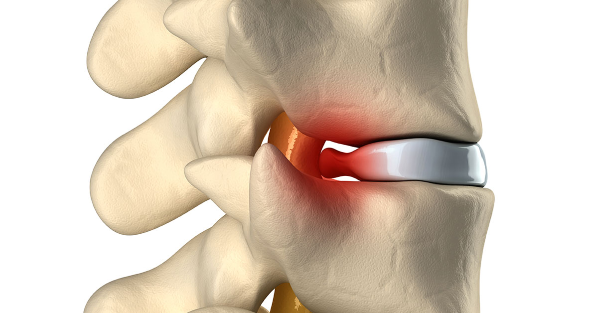 Radiculopathy PracticeMarketingRx